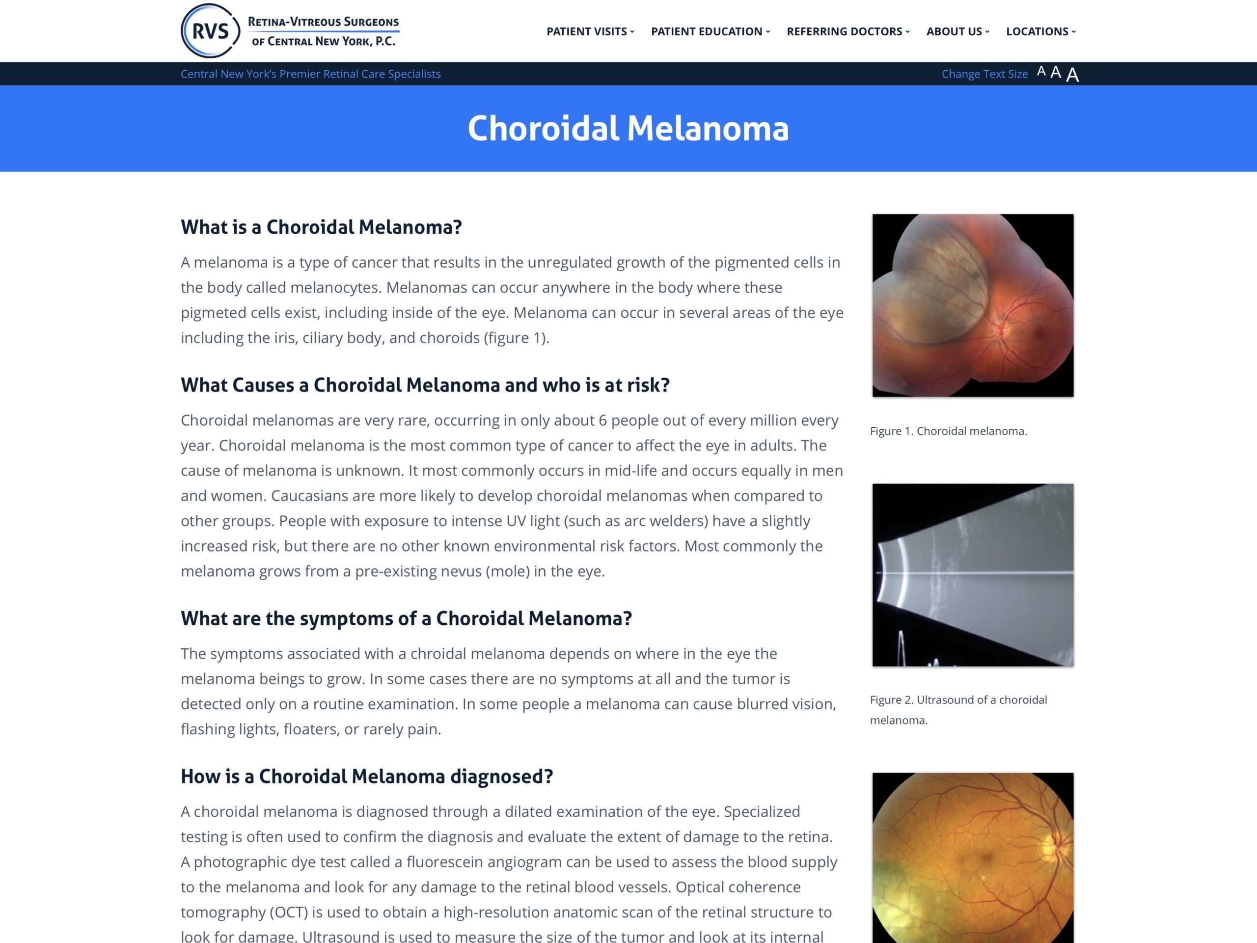 Choroidal Melanoma - Retina-Vitreous Surgeons of CNY