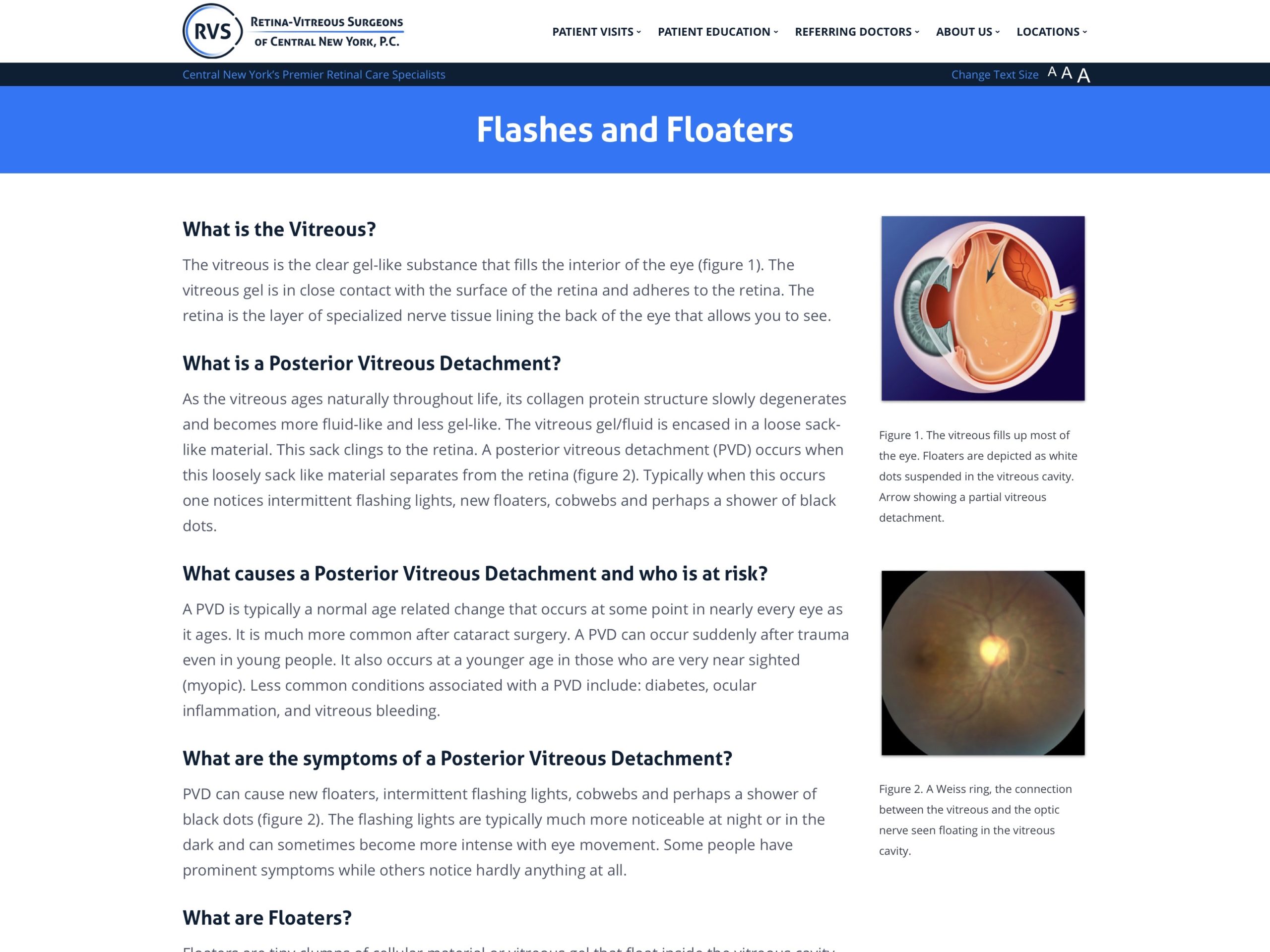 Flashes and Floaters - Retina-Vitreous Surgeons of CNY