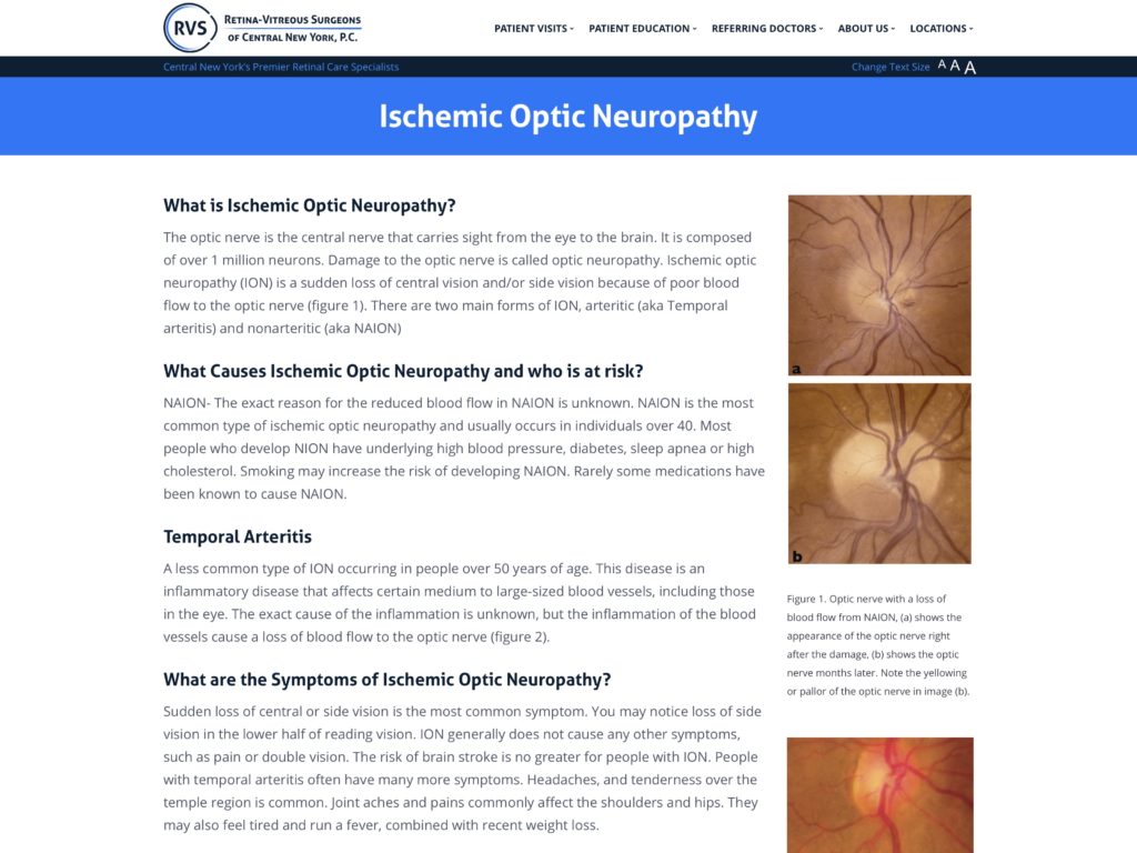 Ischemic Optic Neuropathy | Retina-Vitreous Surgeons of CNY
