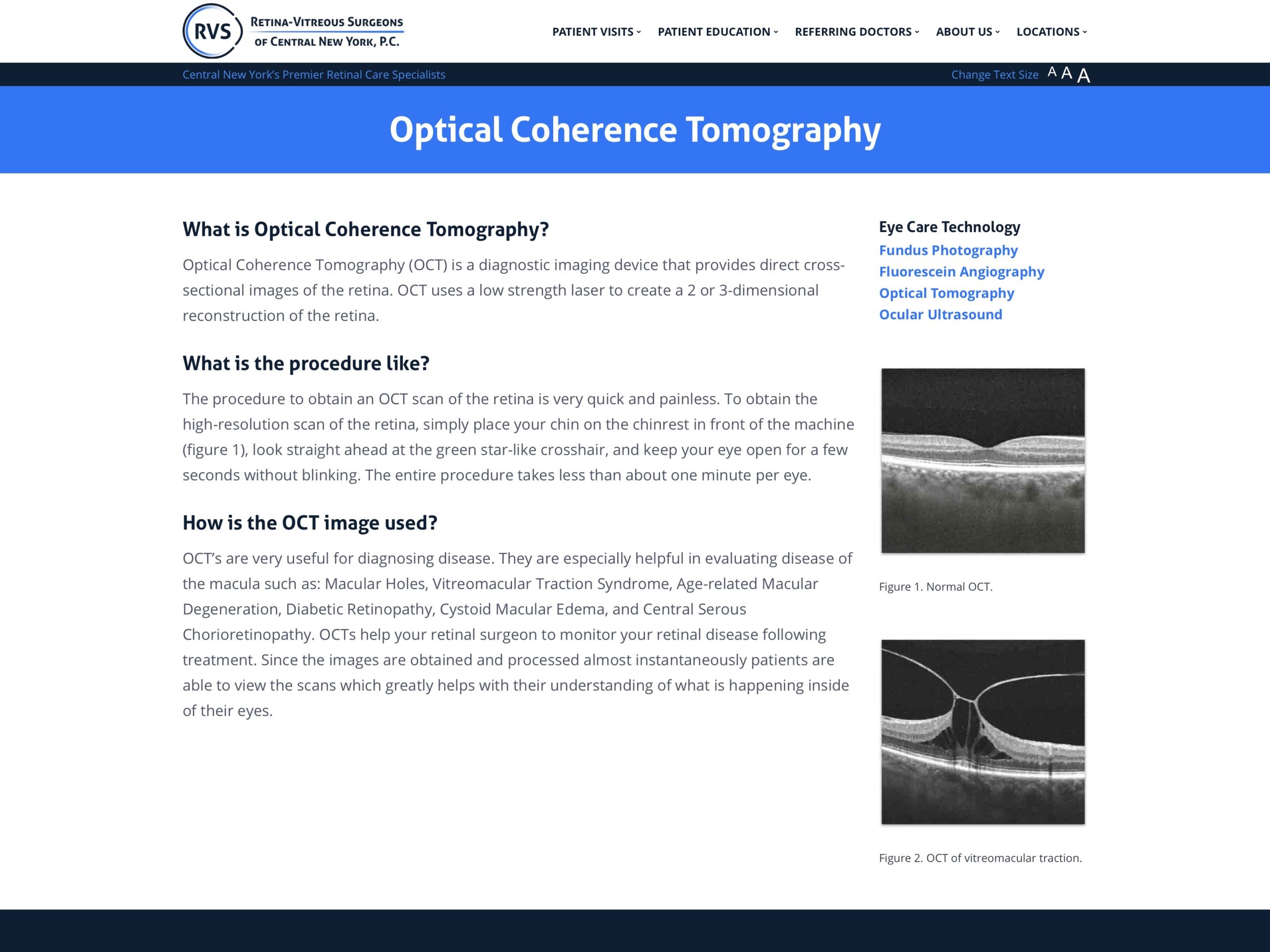 Optical Coherence Tomography - Retina-Vitreous Surgeons of CNY
