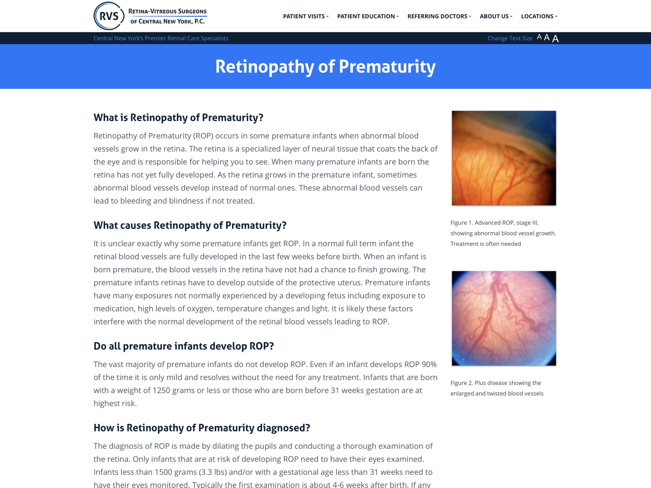 Retinopathy of Prematurity - Retina-Vitreous Surgeons of CNY