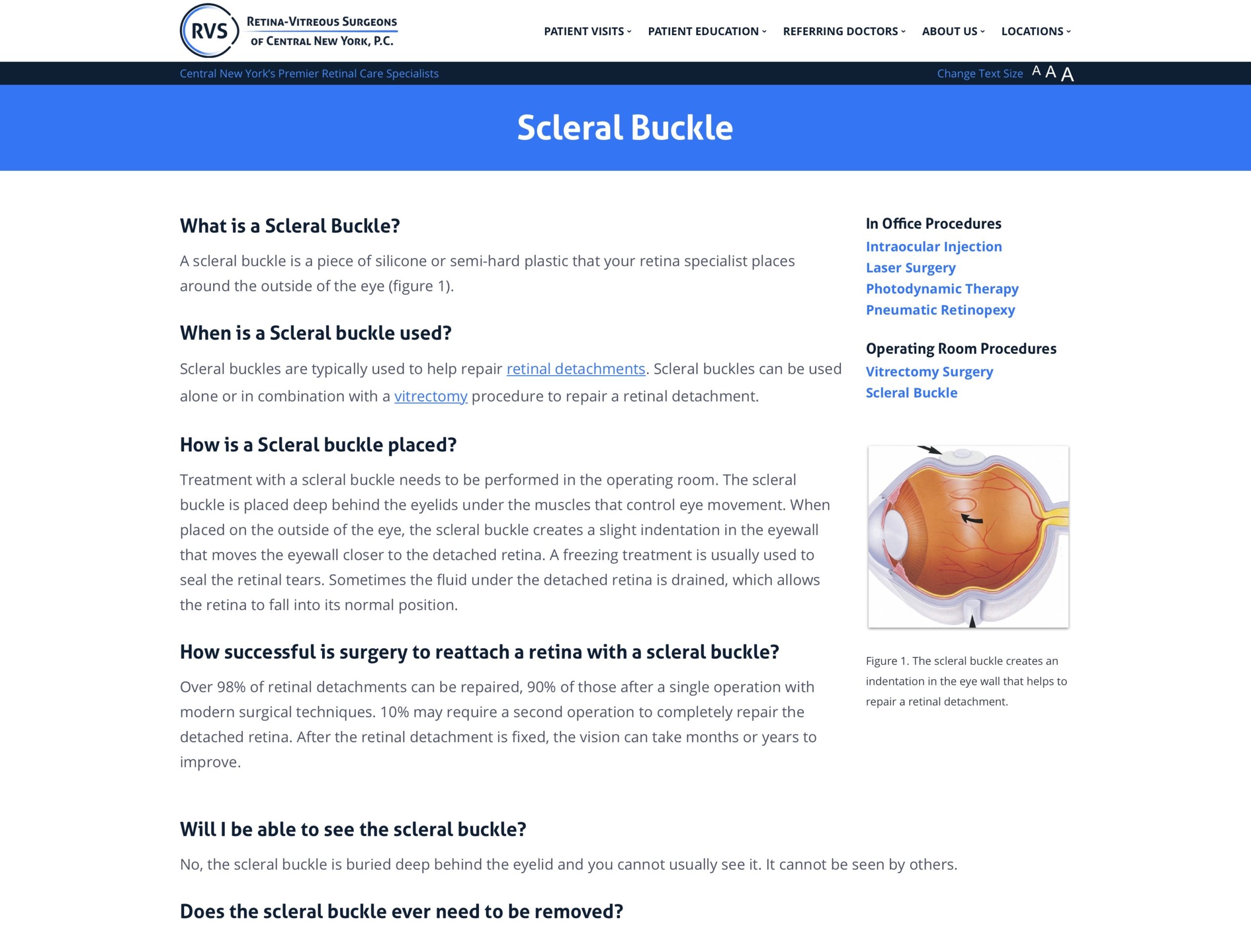 Scleral Buckle - Retina-Vitreous Surgeons of CNY