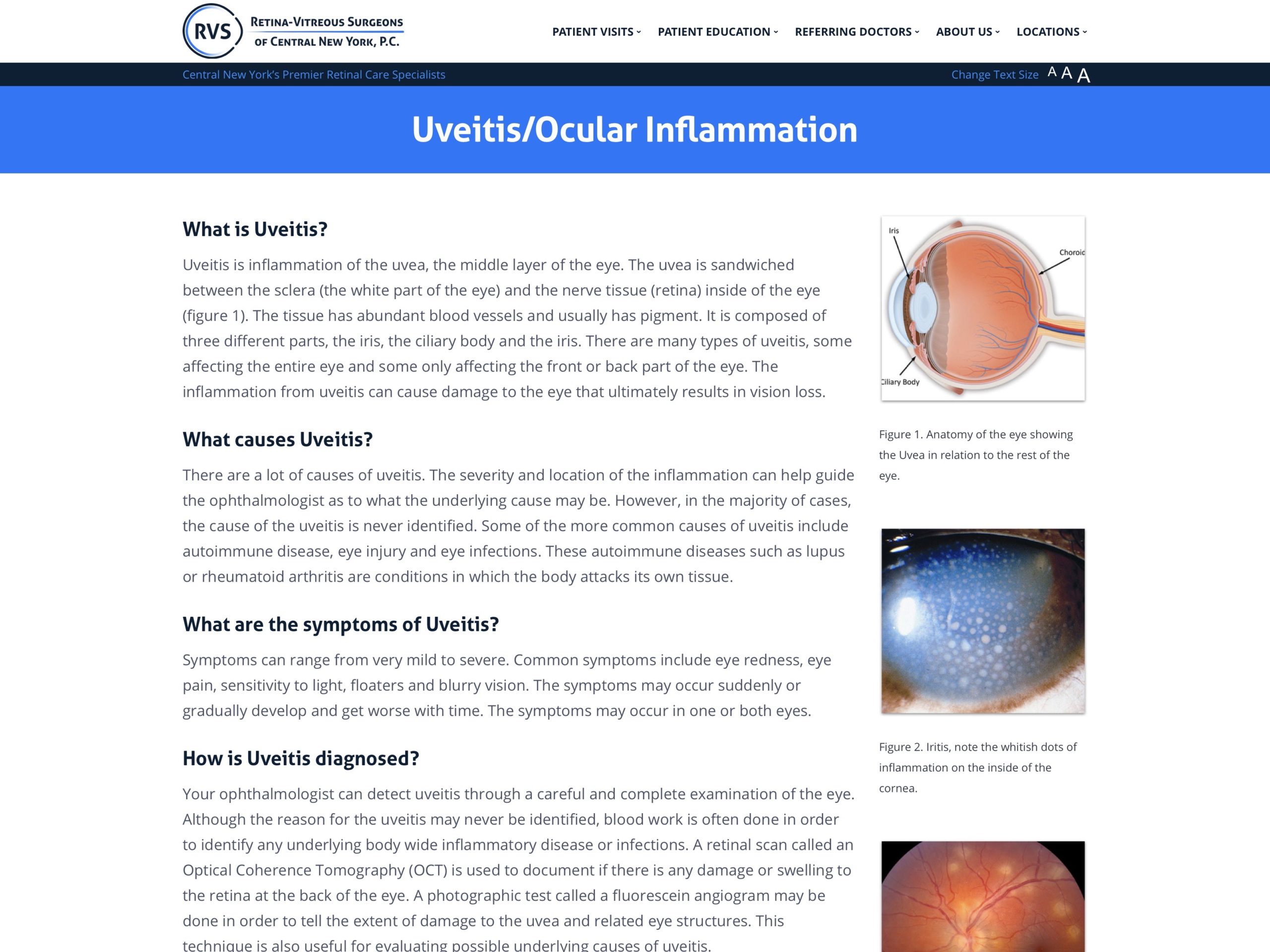 Uveitis Causes Uveitis Treatment Fitchburg MA Uveitis Surgery West